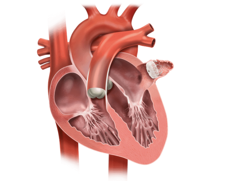 What You Need To Know About WATCHMAN Implants | Mowery Clinic